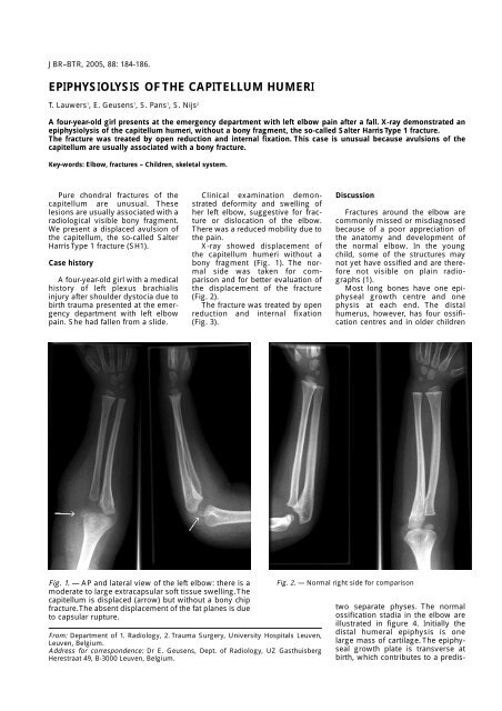 EPIPHYSIOLYSIS OF THE CAPITELLUM HUMERI - rbrs