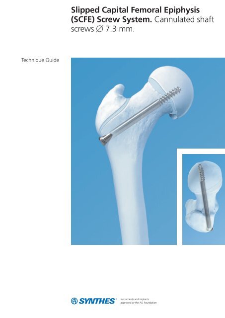 Slipped Capital Femoral Epiphysis (SCFE) Screw System ... - Synthes