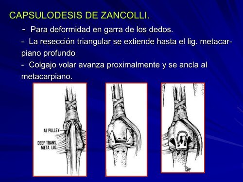 CAPSULODESIS DE ZANCOLLI.
