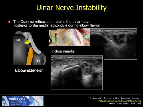 UN * FCU Cubital Tunnel S