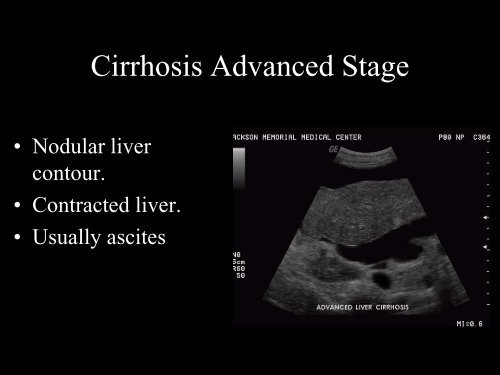 Nodular liver contour