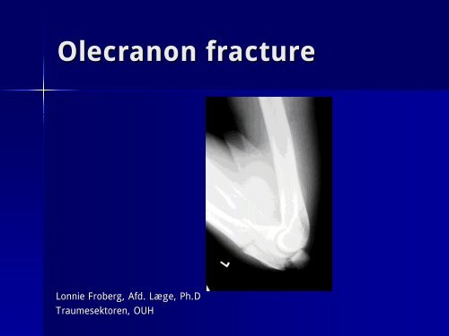 Olecranon fraktur