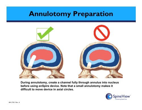 MK 2783 Rev. A Annulotomy