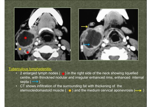 Tuberculous Lymph