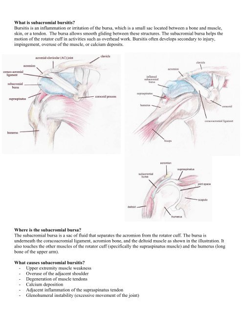 Subdeltoid Bursitis