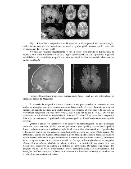 No RN pré-termo, a apres