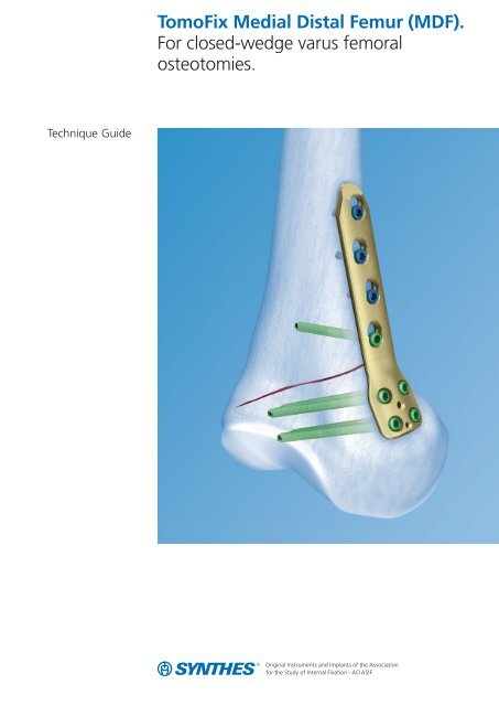 TomoFix Medial Distal Femur (MDF). For closed-wedge ... - Synthes