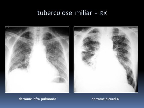 tuberculose miliar - RX