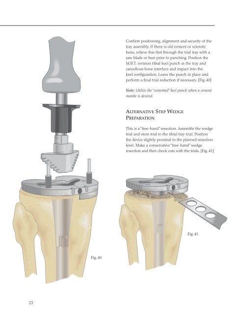 Trim the tibia accordingl