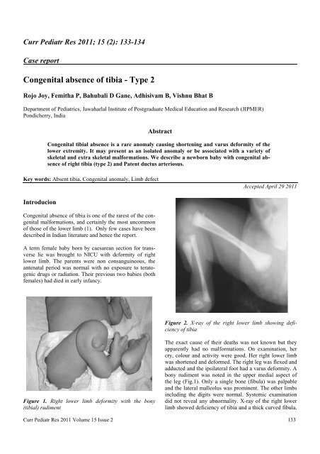 Congenital absence of tibia