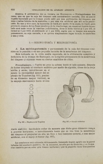 1,— MIRINGOTOMÍA Y MIRINGECTOMÍA o