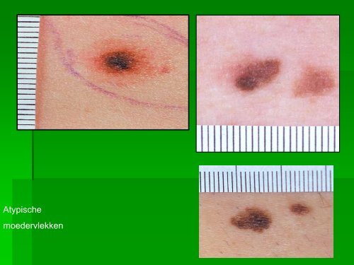 Atypische moedervlekken