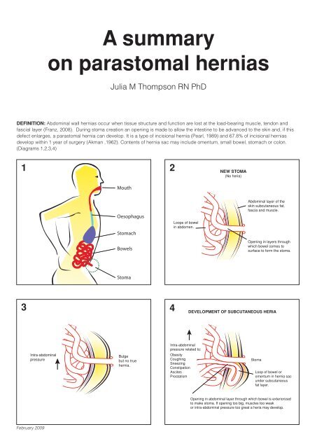 A summary on parastomal hernias - Omnigon - Stoma Support ...