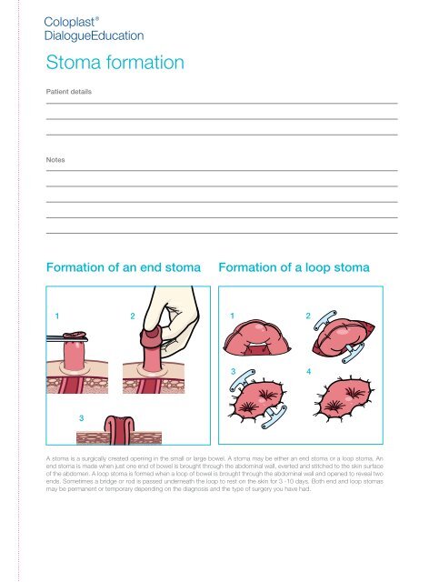 Stoma formation - Coloplast