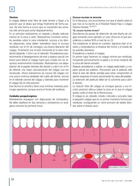 Técnica: El colgajo debe