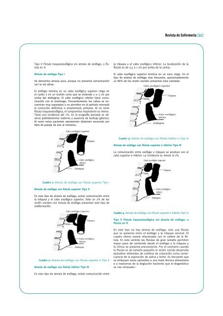 Tipo V Fístula traqueoes
