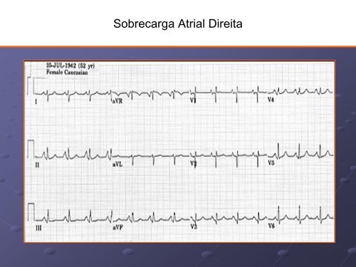 Sobrecarga Atrial Esquerd