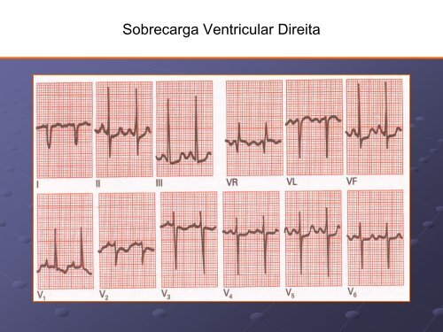 Sobrecarga Ventricular Di