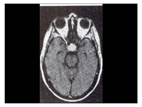 TUMORES CEREBRALES SUPRATENTORIALES E ...