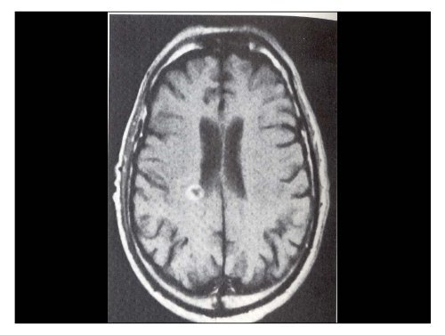 TUMORES CEREBRALES SUPRATENTORIALES E ...