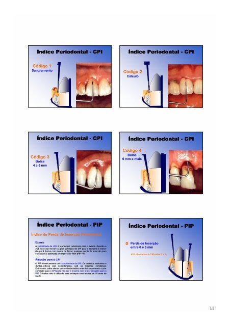 Índice Periodontal - CPI