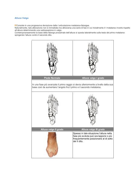 Alluce Valgo Piede Normale Alluce valgo I grado ... - Ilcentrosanitario