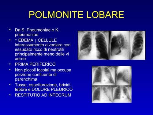 POLMONITE LOBARE • Da S