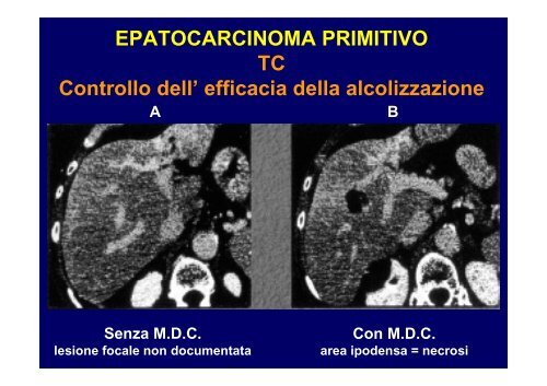 EPATOCARCINOMA PRIMITIVO