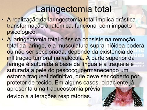 Laringectomia total