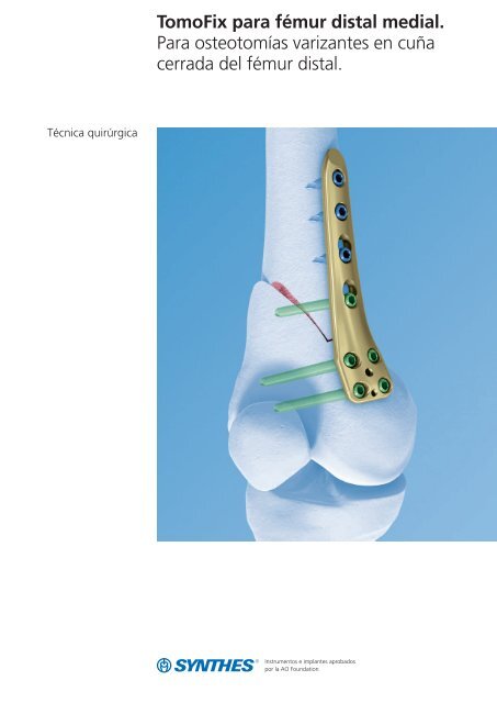 tomofix para fémur distal medial. técnica quirúrgica - Synthes