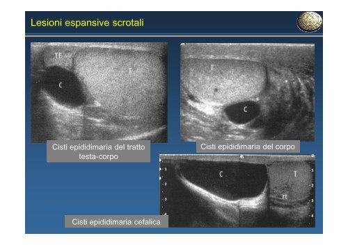 Lesioni espansive scrotal
