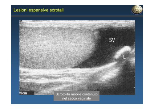Lesioni espansive scrotal