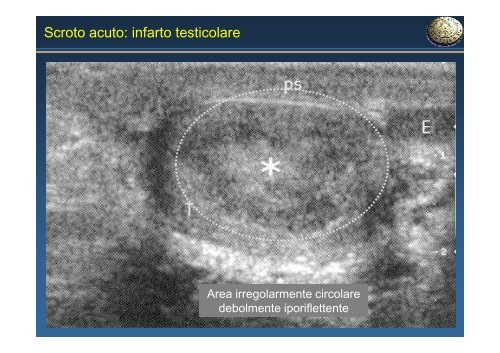 Scroto acuto: infarto tes