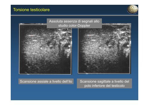 Torsione testicolare Asso