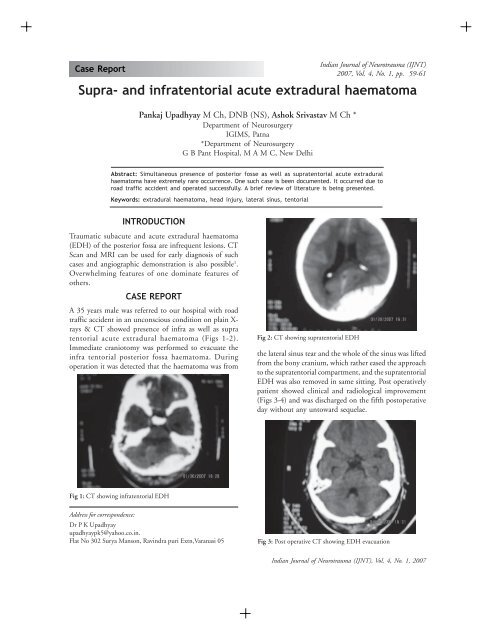 Supra- and infratentorial acute extradural haematoma - medIND