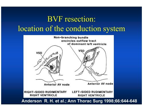 BVF resection