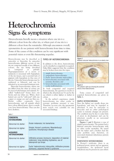Fuchs Heterochromic Iridocyclitis