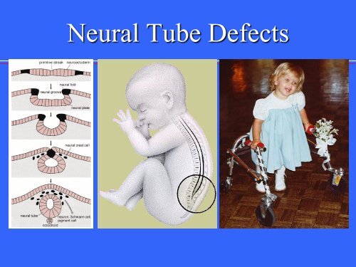 Neural Tube Defects Ntd Medchrome