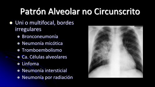 Patrón Alveolar no Circu
