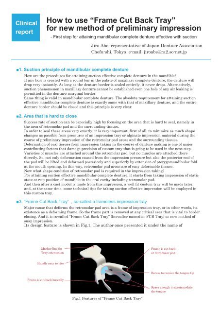 How to use “Frame Cut Back Tray” - JDA | Japan Denture Association