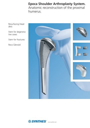 Condylar Head Add-on System. Adjustable system for ... - Synthes