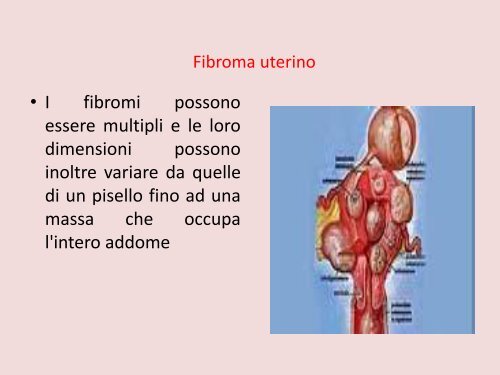 I fibromi