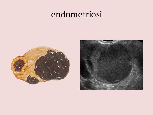 endometrio