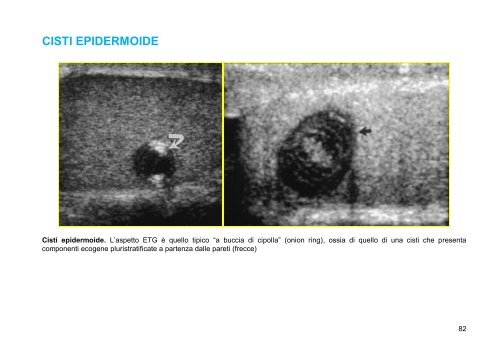 CISTI EPIDERMOIDE Cisti E cisti-epidermoide-cisti-e