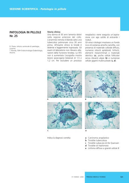 Tiroidite subacuta di De Quervain