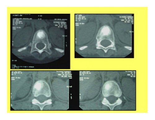 OptiMesh con osso omologo : indicazione, tecnica ... - Spineology
