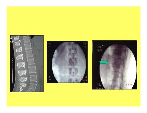 OptiMesh con osso omologo : indicazione, tecnica ... - Spineology