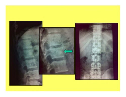 OptiMesh con osso omologo : indicazione, tecnica ... - Spineology
