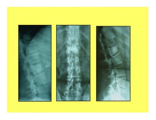 R.D donna 51 anni fratt.