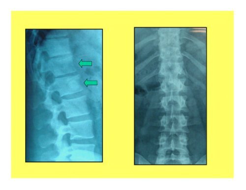 OptiMesh con osso omologo : indicazione, tecnica ... - Spineology